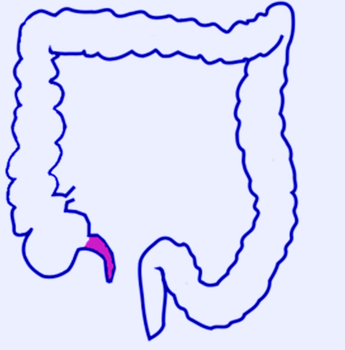 Appendix Pain - Location, Symptoms, Causes, Diagnosis, Treatment ...